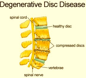 Treating Degenerative Disc Disease - ChiroPlus Wellness Care in Aurora, CO